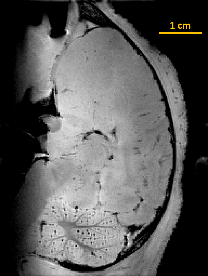 Magnetic resonance imaging